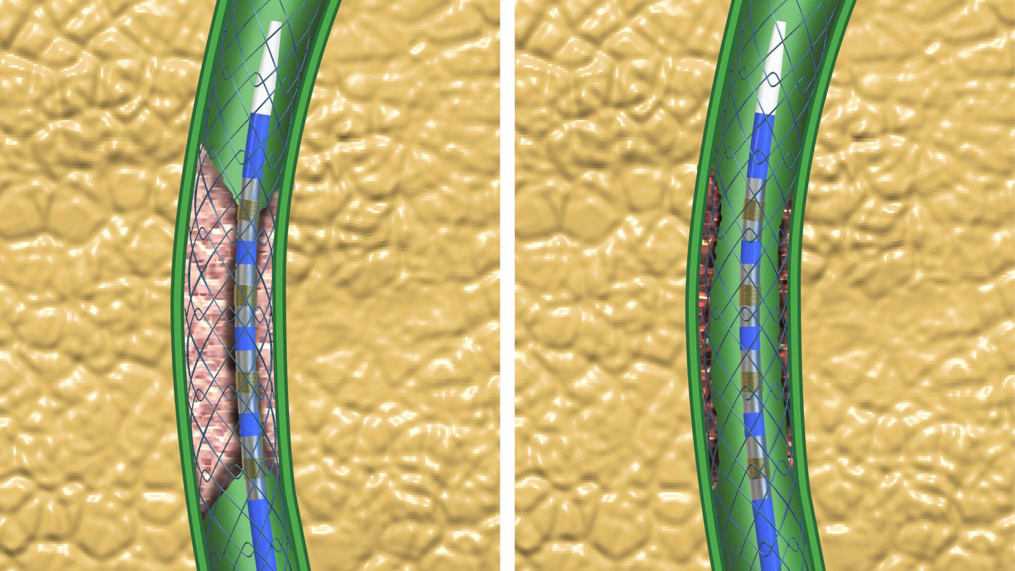 Niti-S Biliary Slim M Stent - TaeWoong Medical USA
